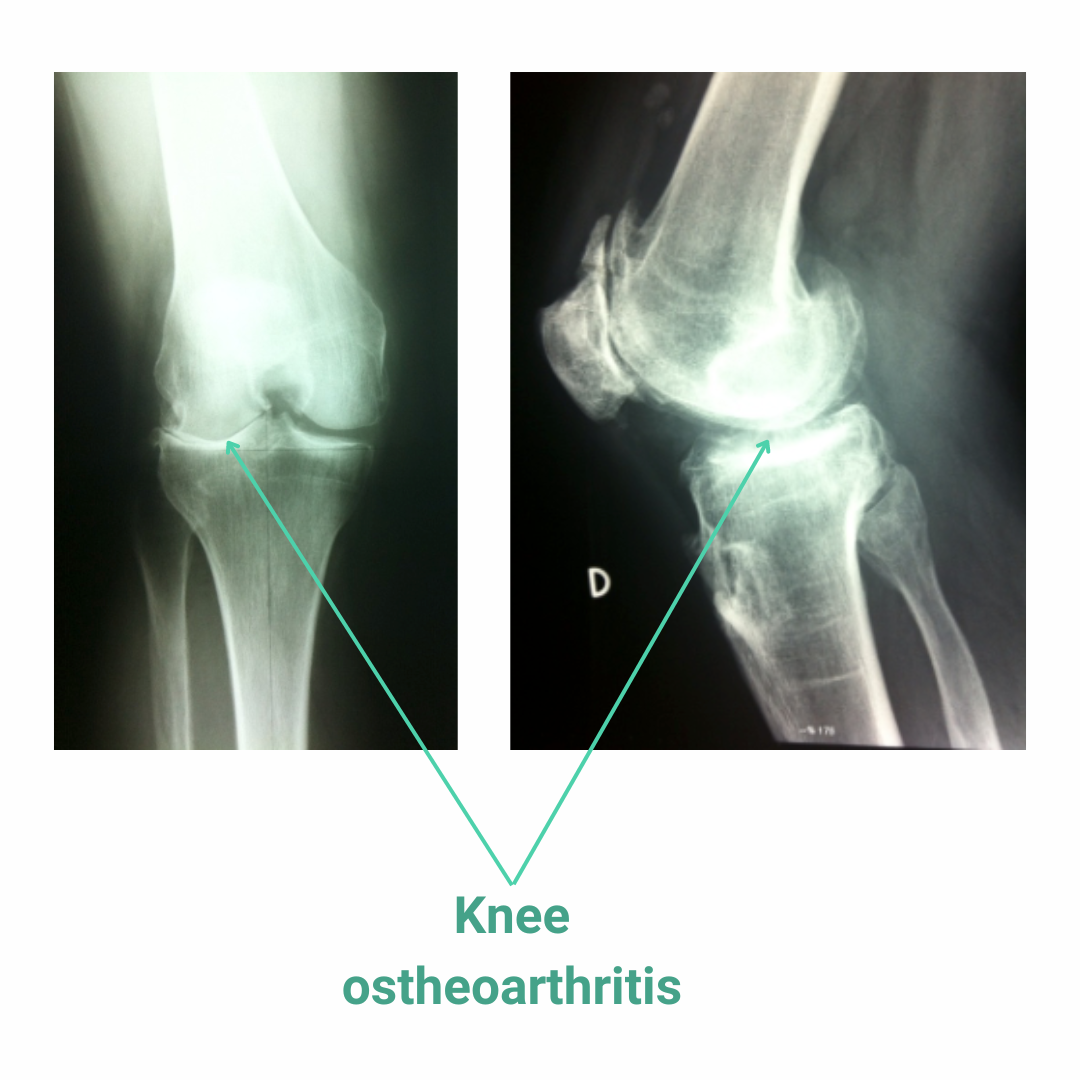 Find out more about osteoarthritis of the hip and knee - Swiss Ortho Clinic